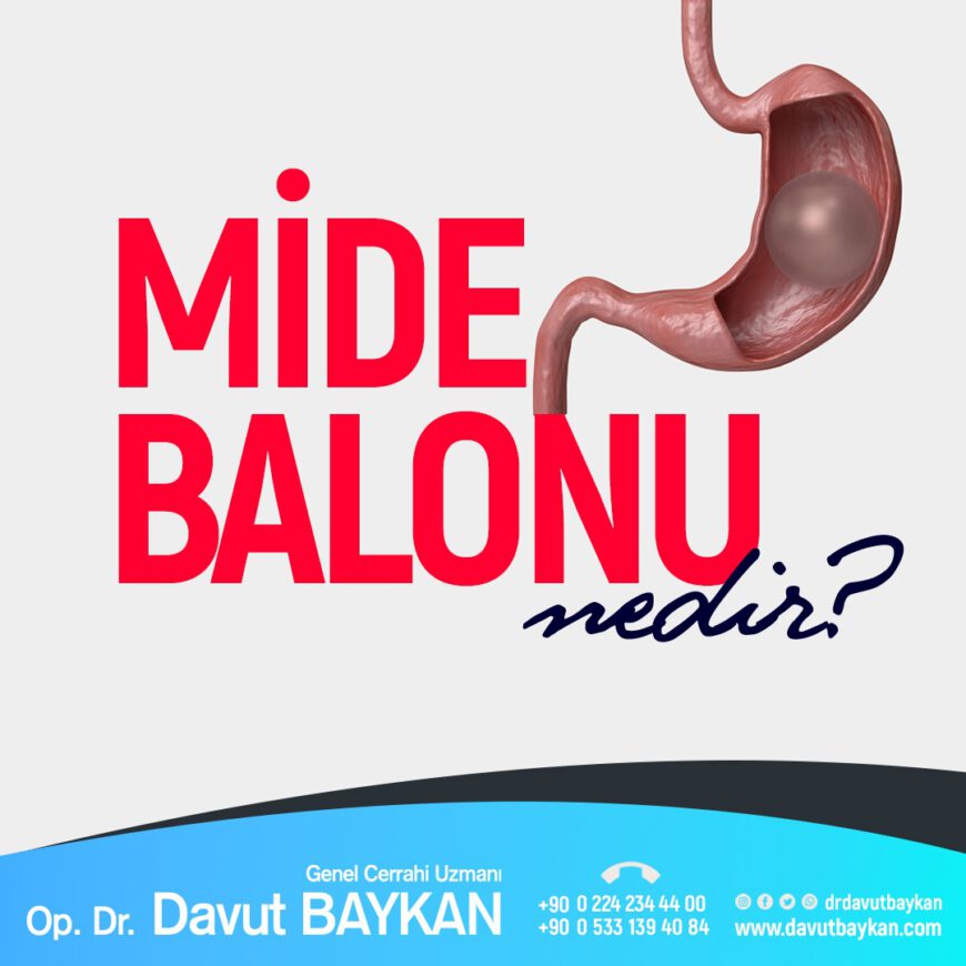 Gastric Balloon - General Surgeon and Bariatric Surgeon Dr. Davut Baykan